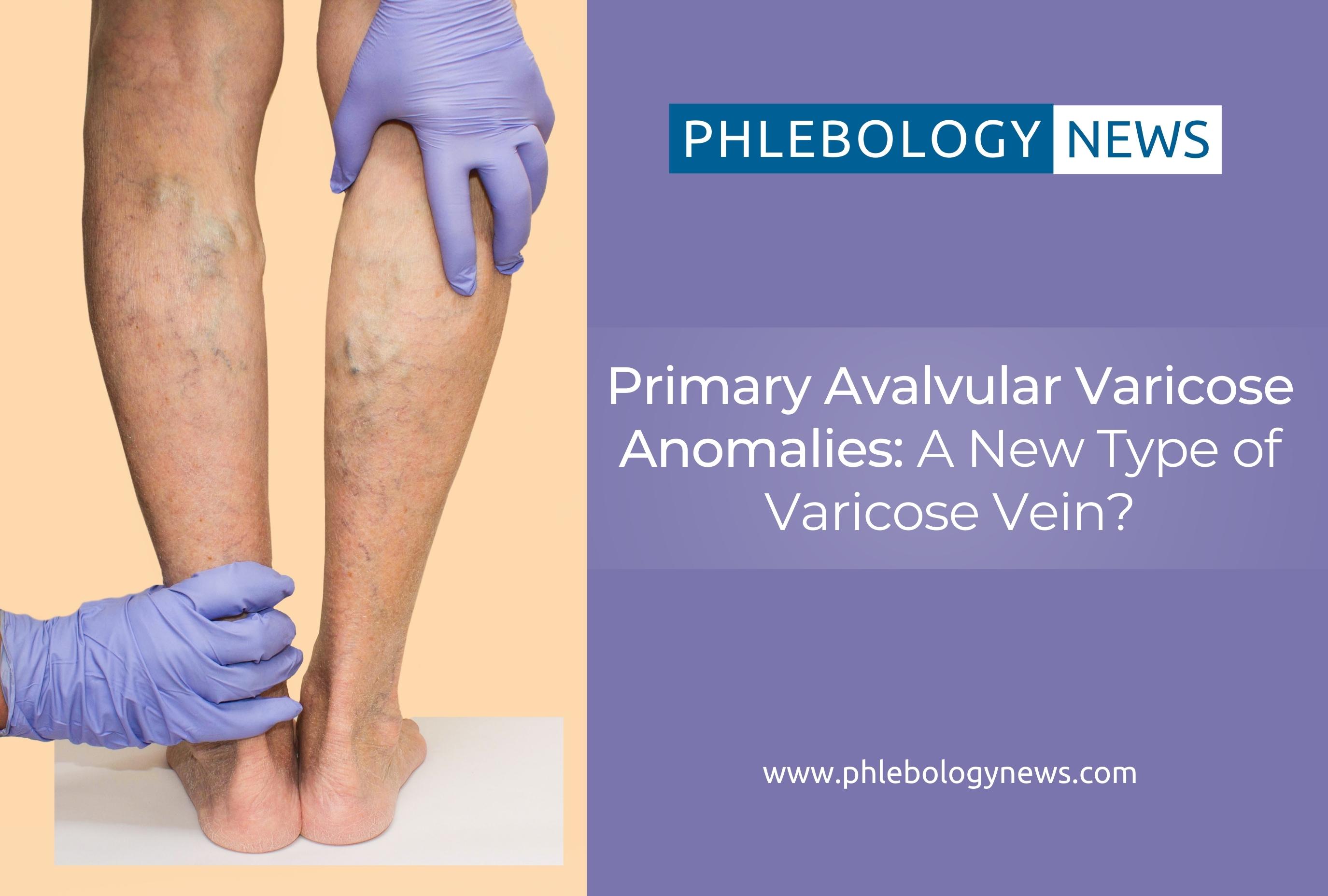 Primary Avalvular Varicose Anomalies: A New Type of Varicose Vein ...